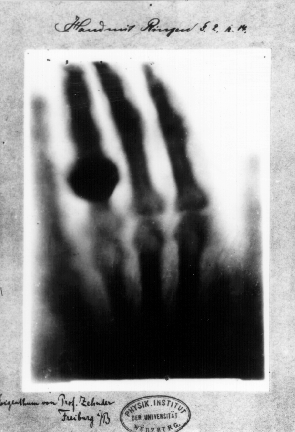 first-xray-hand | Vesta Teleradiology